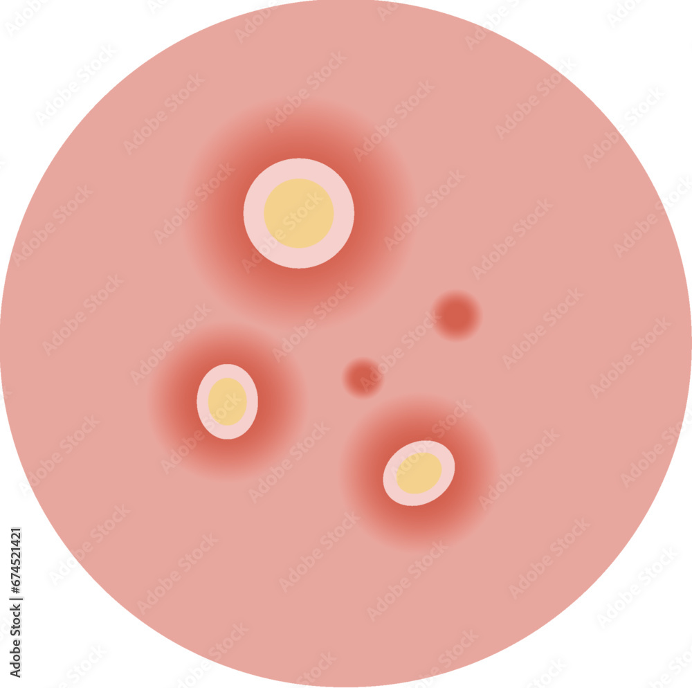Skin pustule problems vector illustration. Sign of dry or oily skin ...