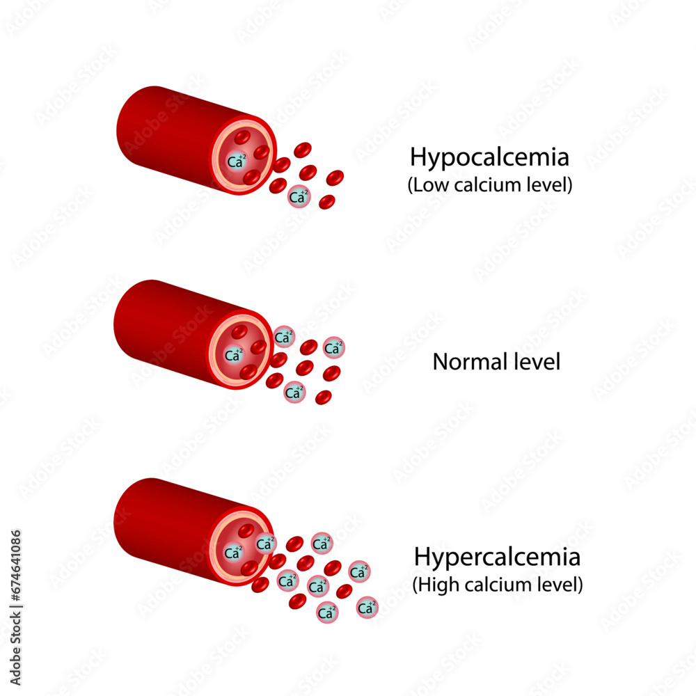 Vecteur Stock hypercalcemia, high plasma calcium level and hypocalcemia ...