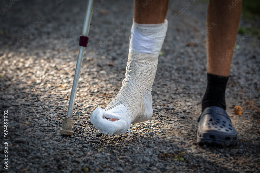 Broken ankle and a leg cast. Leg splint Stock Photo | Adobe Stock