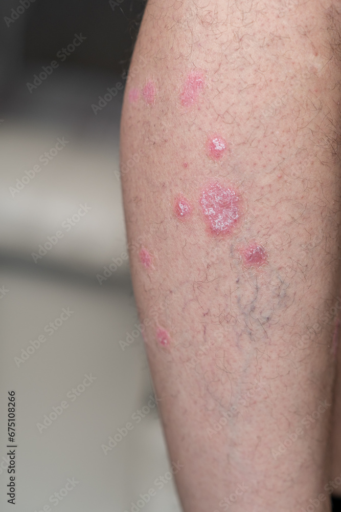 Foto de Psoriasis Vulgaris, skin patches are typically red, itchy, and ...