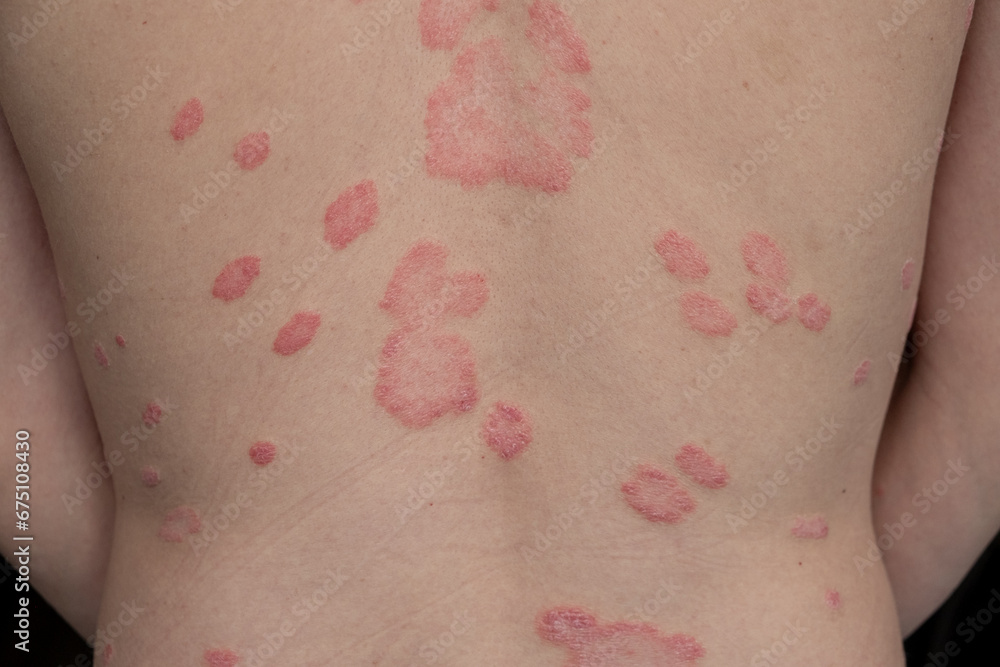 Foto de Psoriasis Vulgaris, skin patches are typically red, itchy, and ...