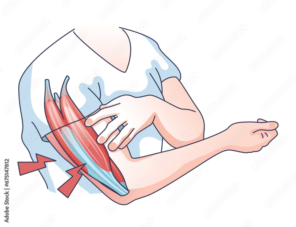 Muscle weakness with weak and fatigue muscular system outline concept ...