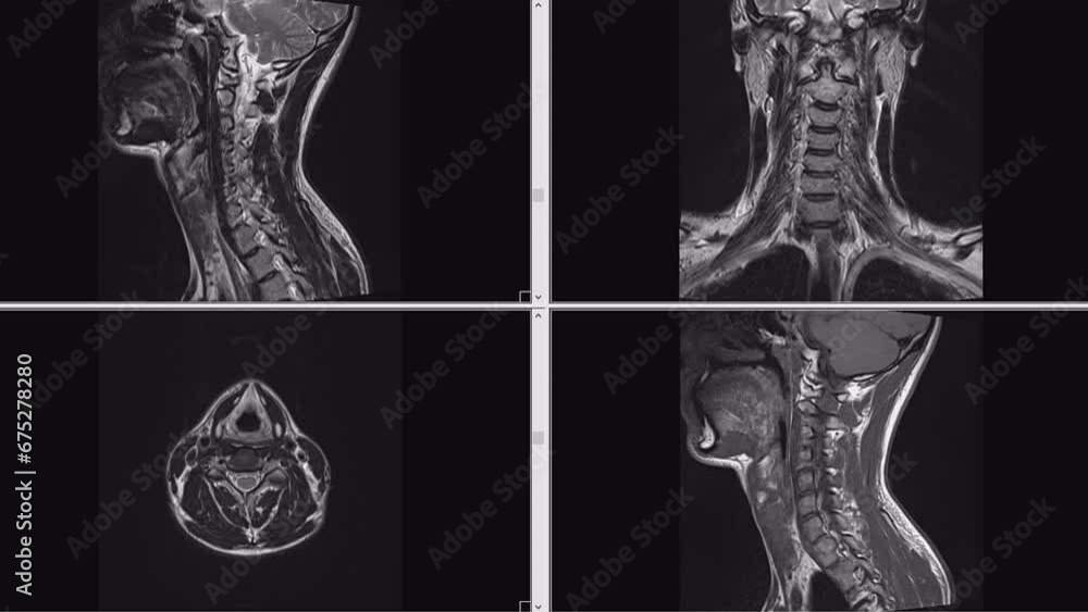 MRI scans of the cervical spine human body. Examining and identifying ...