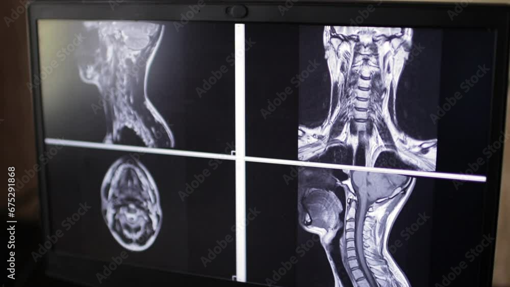 MRI scans of the cervical spine human body. Examining and identifying ...