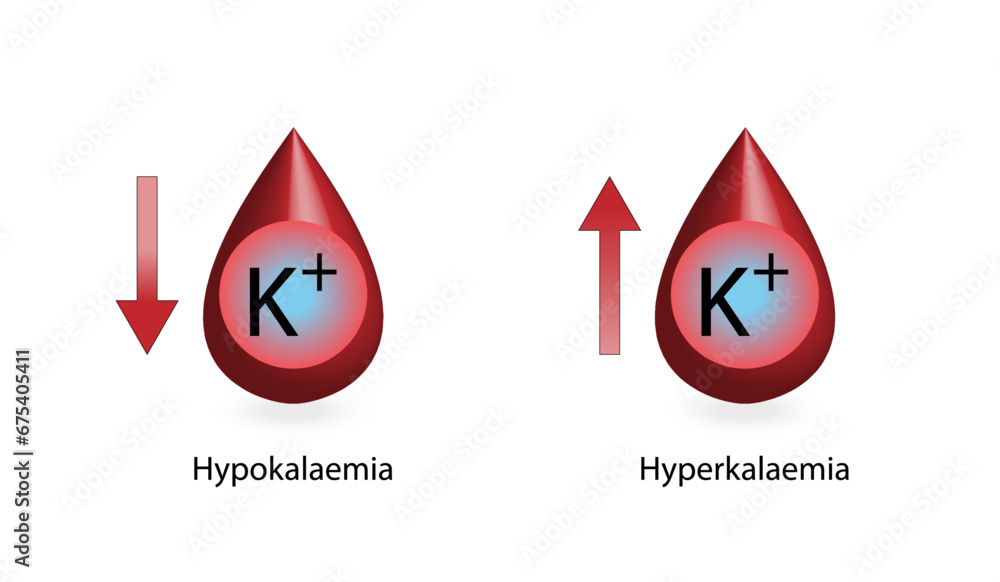 Hyperkalaemia, high plasma potassium level and Hypokalaemia, low plasma ...