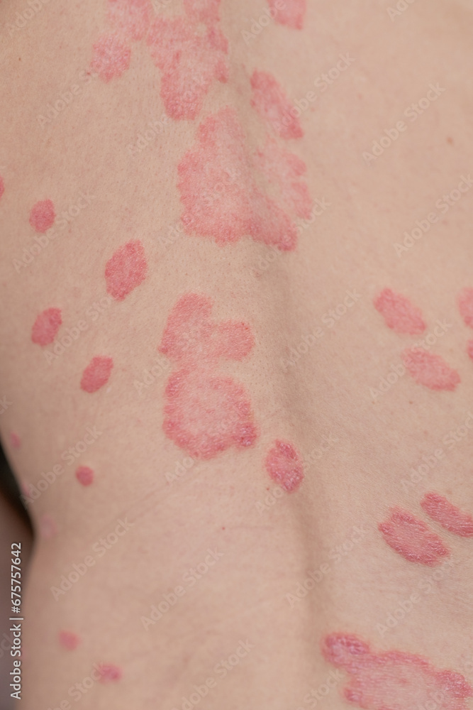 Foto de Psoriasis Vulgaris, skin patches are typically red, itchy, and ...