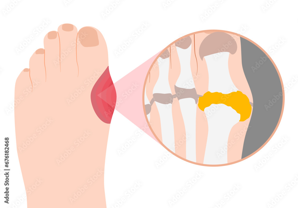 Gout is a type of inflammatory arthritis that causes pain and swelling ...