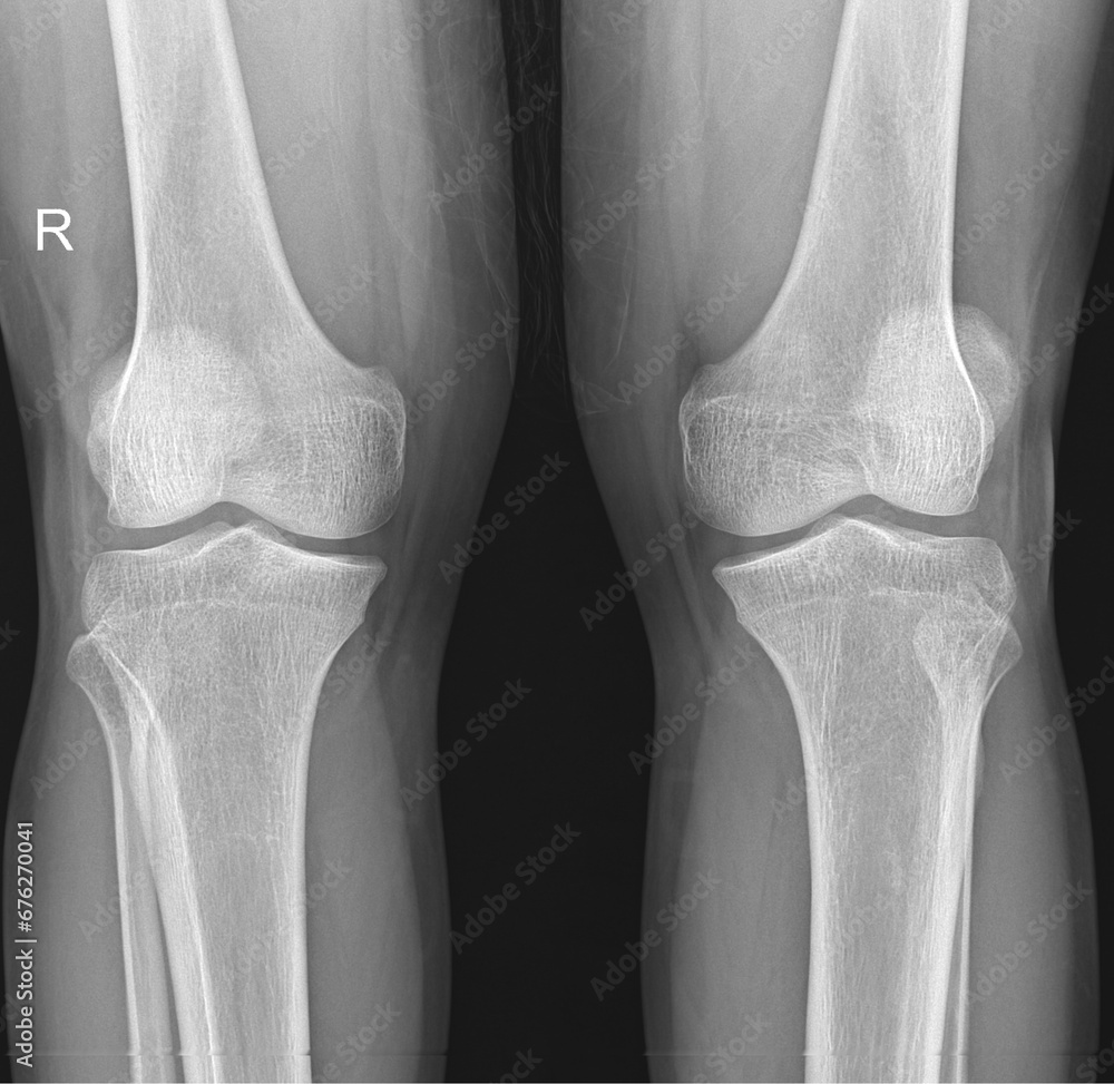 Precision X ray image of bilateral knee, emphasizing joint integrity ...