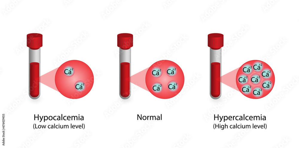 Hypercalcemia, high plasma calcium level and hypocalcemia, low plasma ...