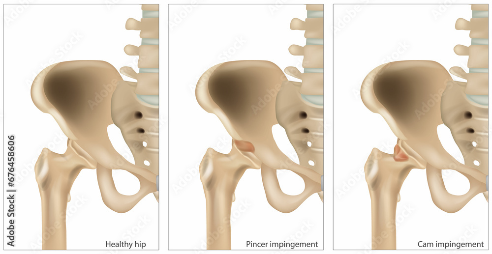 Illustration of the Femoroacetabular Impingement. Different of the Cam ...