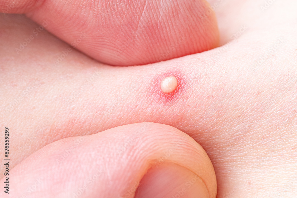 Fotka „Pimple, acne or comedones. Inflamed pimples, pustules, cysts ...