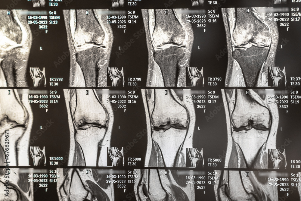 Knee joint x-ray or MRI. Doctor pointed on area of knee joint, where ...