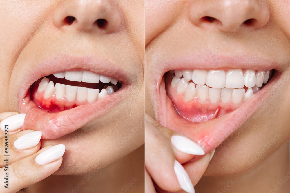 Two shots of a young woman with red bleeding gums and health gums ...