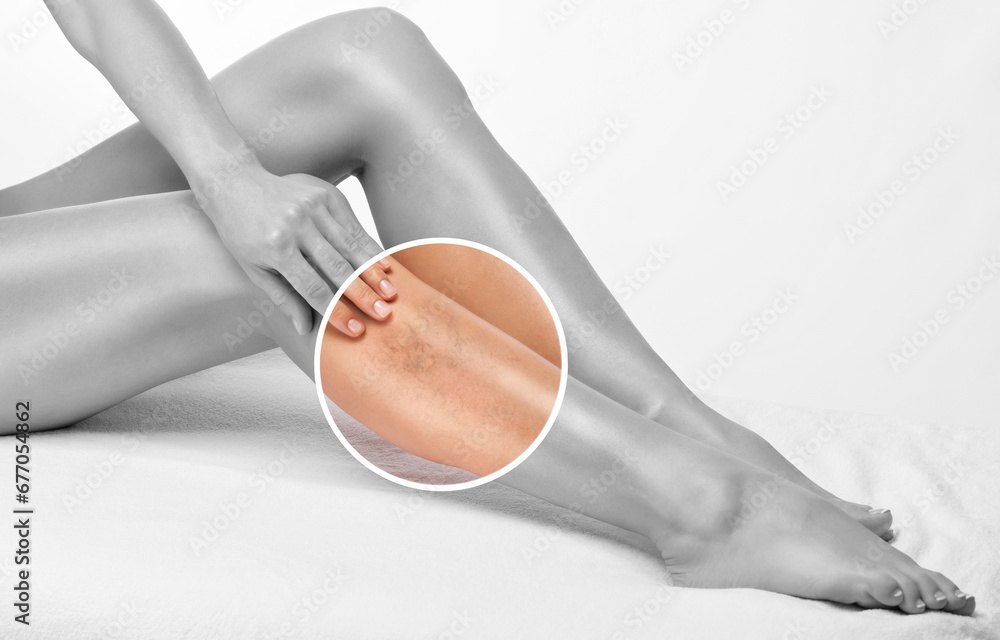 The woman shows the dilation of small blood vessels of the skin on the ...