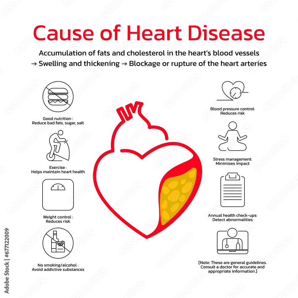 Cause of Heart Disease infographic Stock Vector | Adobe Stock