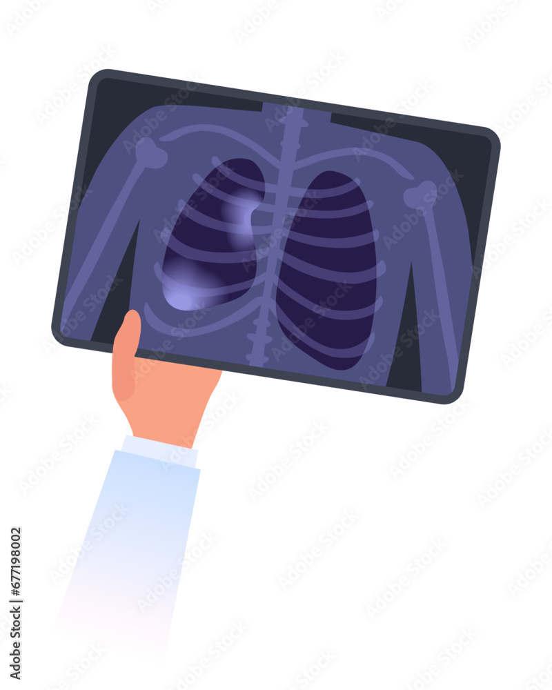 Healthy and collapsed lung x-ray image. Doctor`s hand holds MRI scan of ...