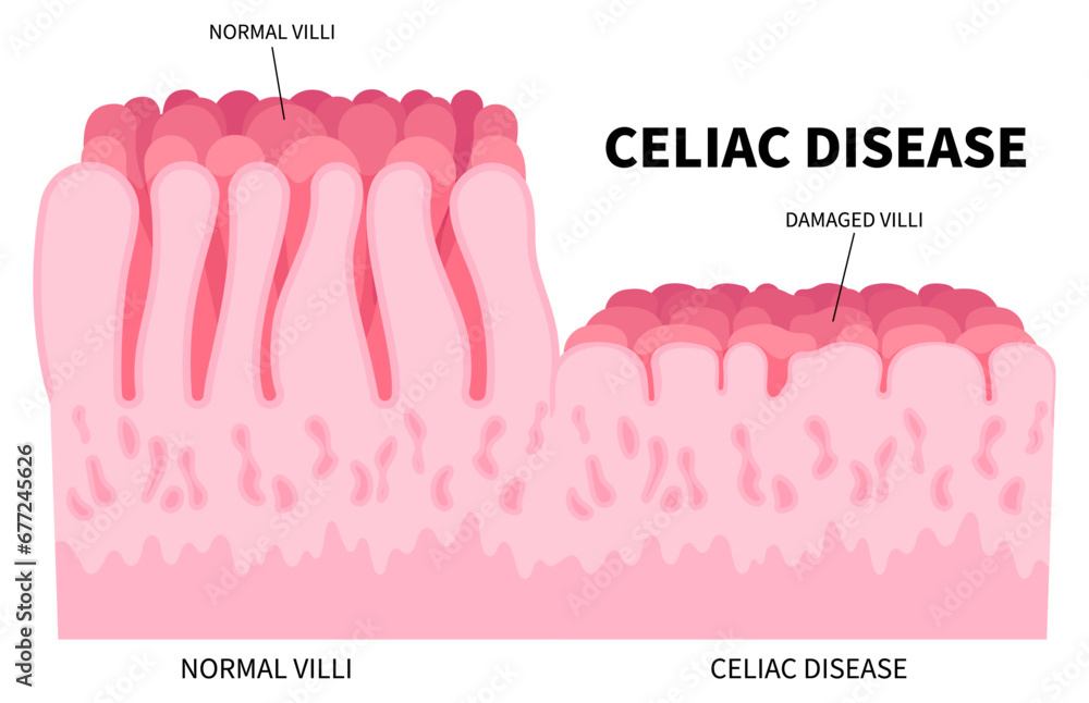 Ulcerative colitis for the small intestinal of Celiac disease with ...