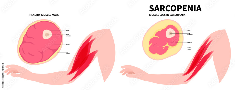 The Sarcopenia disorder that cause arm and leg muscle loss in older ...