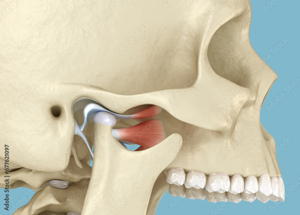 TMJ: The temporomandibular joints dislocation. 3D illustration. Stock ...