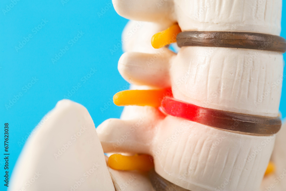 Poster Red inflamed intervertebral disc herniation on a medical model ...