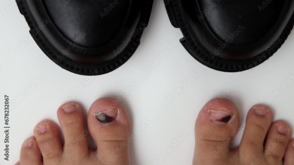 hematoma wound on runner's toe nail. consequences of wearing ...