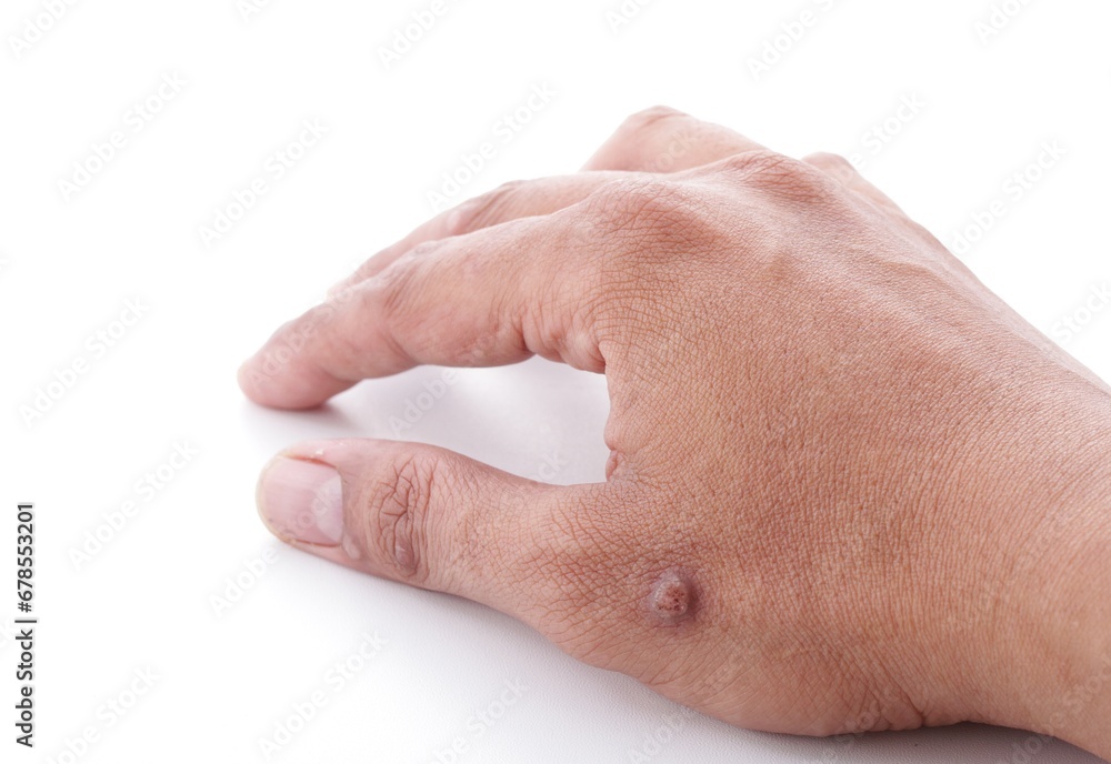 Warts in medical terms are called Papillomas. Papilloma is actually a ...