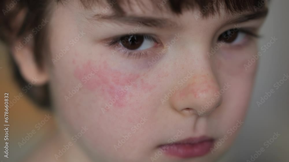 Boy Has Dry Red Skin and Scratching Her Face. Child Scratches Atopic ...