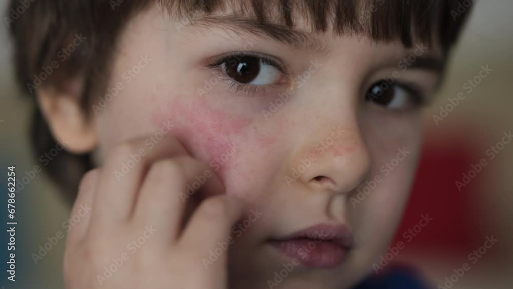 Boy Has Dry Red Skin and Scratching Her Face. Child Scratches Atopic ...