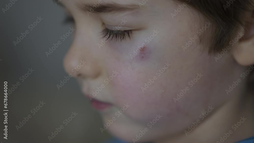 Video „Portrait of Face of Unhappy Boy With Blue And Red Bruise Near ...