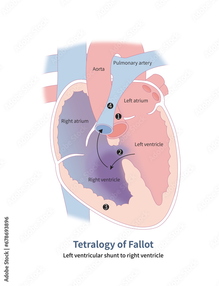 Four anatomical malformations of tetralogy of Fallot: 1 aortic straddling; 2 ventricular septal ...