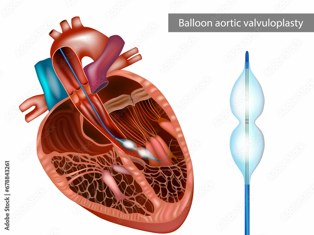 Balloon aortic valvuloplasty or BAV. The balloon catheter is advanced ...