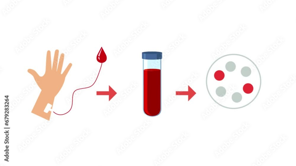 A tube filled with blood for the injection of platelet-rich plasma. PRP ...
