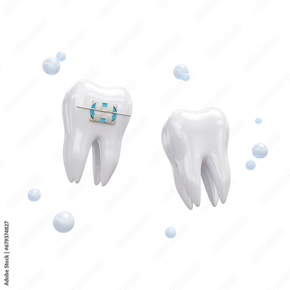 3d tooth isolated on transparent background. Teeth metal braces. Teeth ...