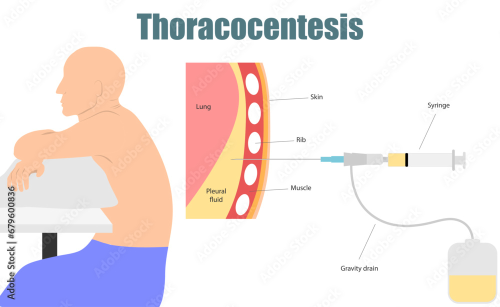 Poster Thoracentesis procedure remove fluid from around the pleural ...