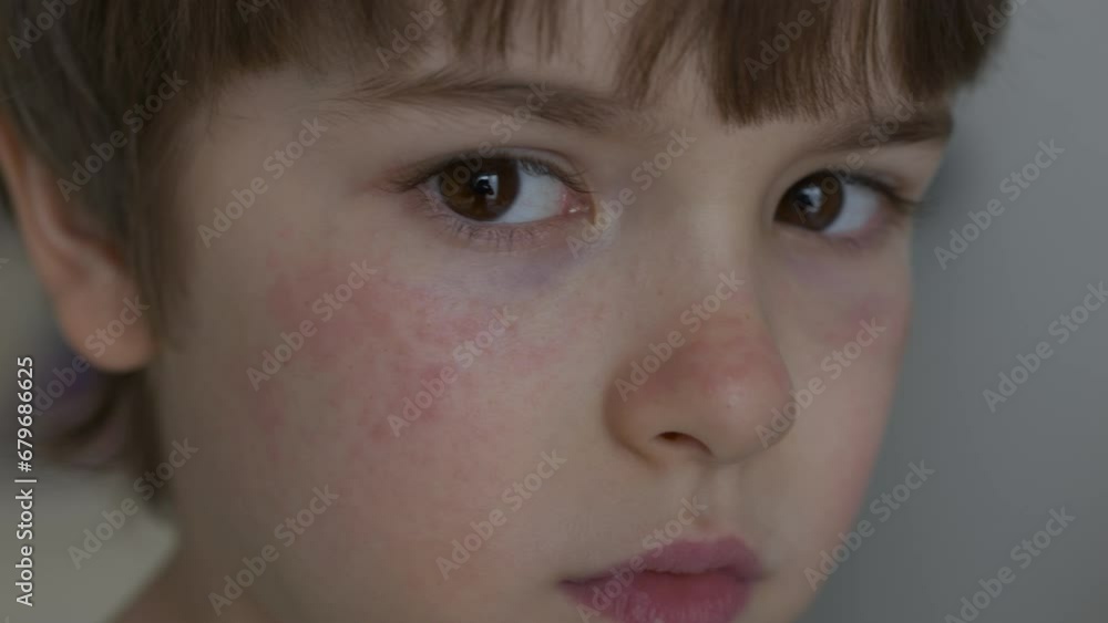 Boy Has Dry Red Skin and Scratching Her Face. Child Scratches Atopic ...