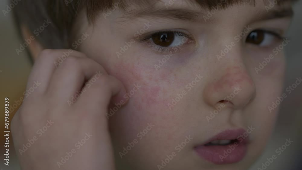 Boy Has Dry Red Skin and Scratching Her Face. Child Scratches Atopic ...