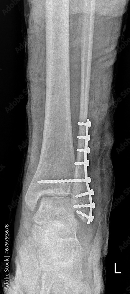 Detailed X-ray image illustrating the successful surgical fixation of a ...