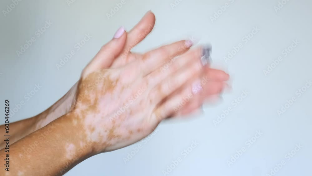 Closeup of hands of girl with vitiligo clapping hands on white ...