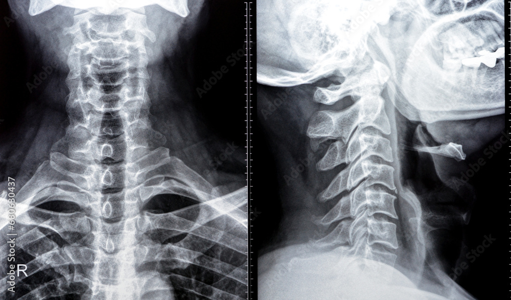 Plain X ray of cervical spine revealed straightened cervical curve ...