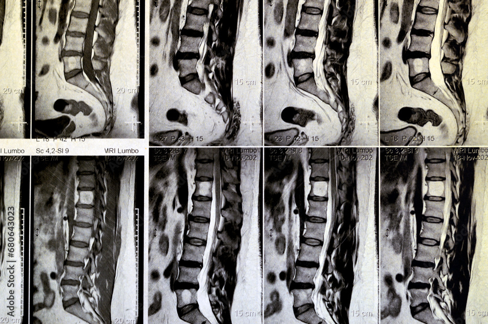 MRI lumbosacral spine without contrast revealed back muscle spasm, Mild ...