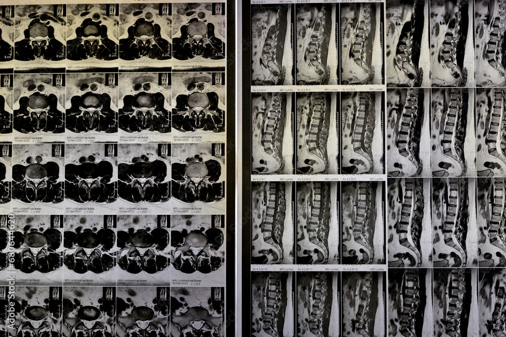 Foto de MRI lumbosacral spine without contrast revealed back muscle ...