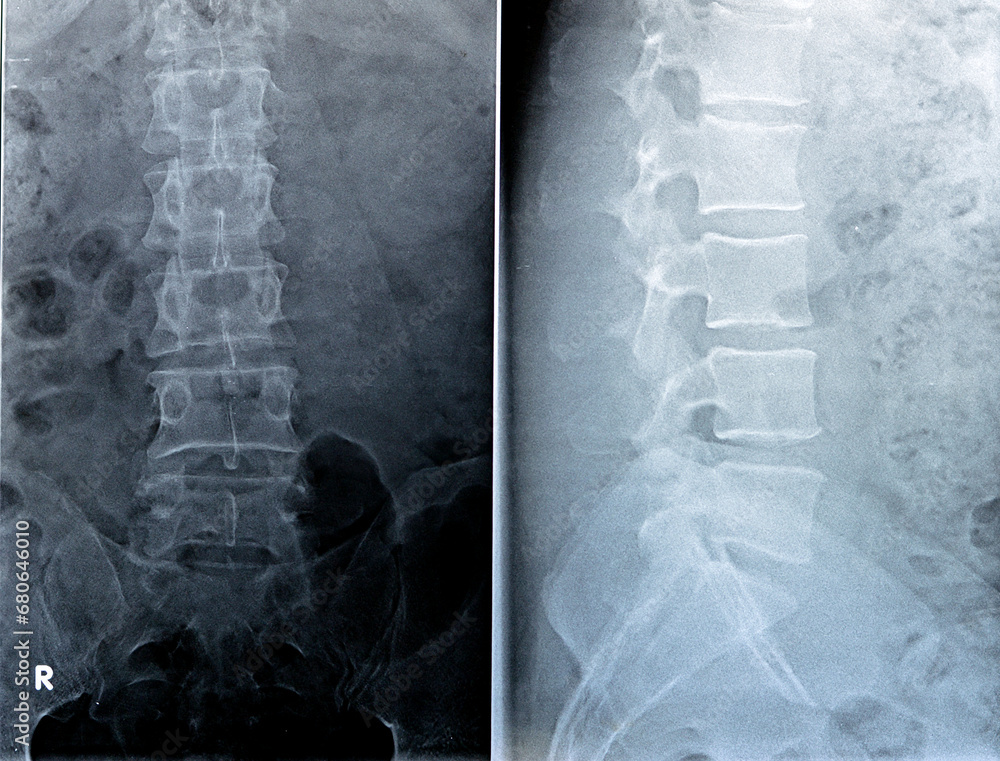 Plain X ray lumbosacral spine revealed straightened, mild scoliotic ...
