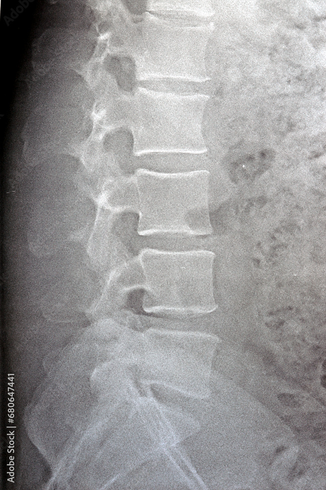 Plain X ray lumbosacral spine revealed straightened, mild scoliotic ...