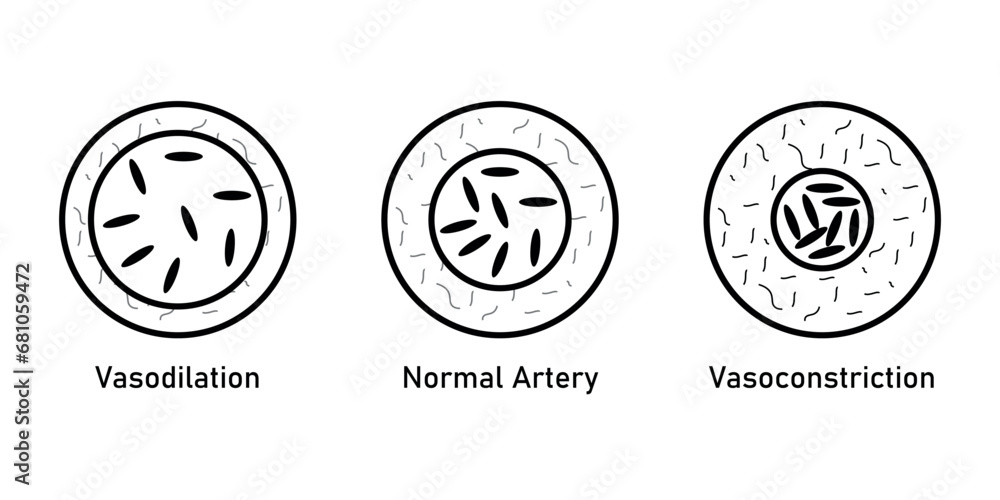 Vasodilation and vasoconstriction. Normal cross section. Normal blood ...