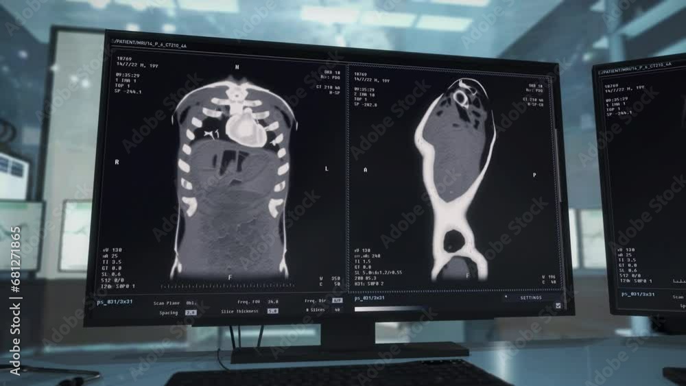 X-ray Analysis Software Inspects Bones In Chest To Diagnose Injury. Medical Analysis In Hospital ...