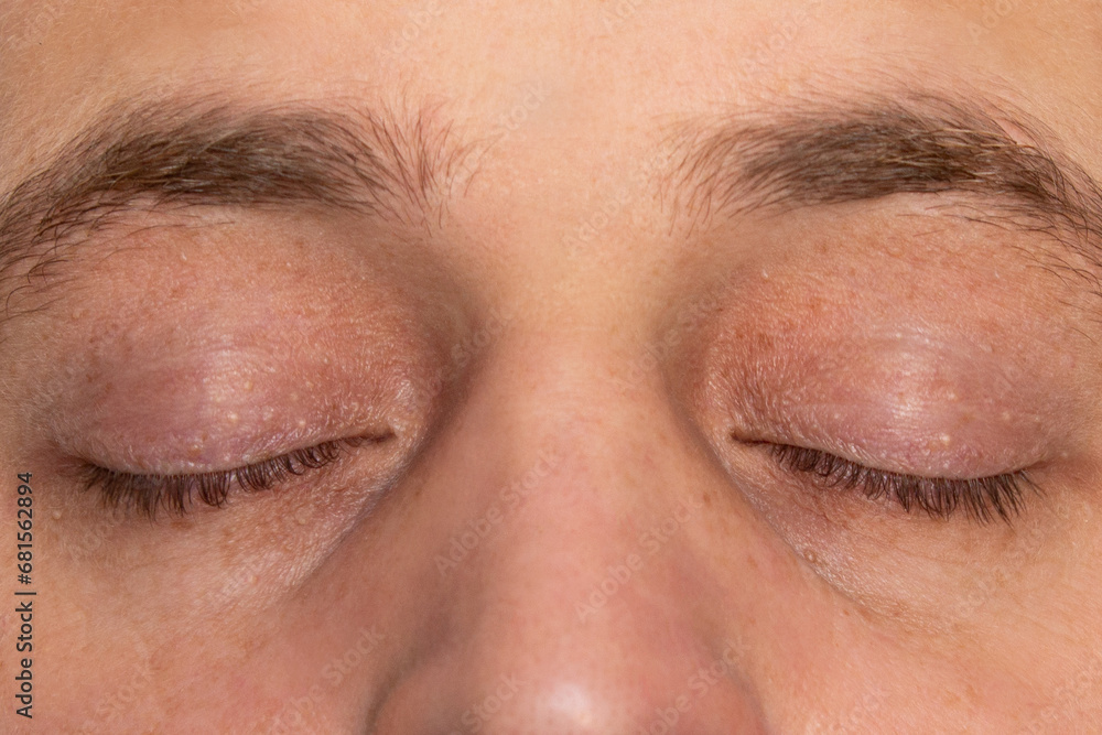 Milia or milium on the upper and lower eyelids of a man. Whiteheads ...