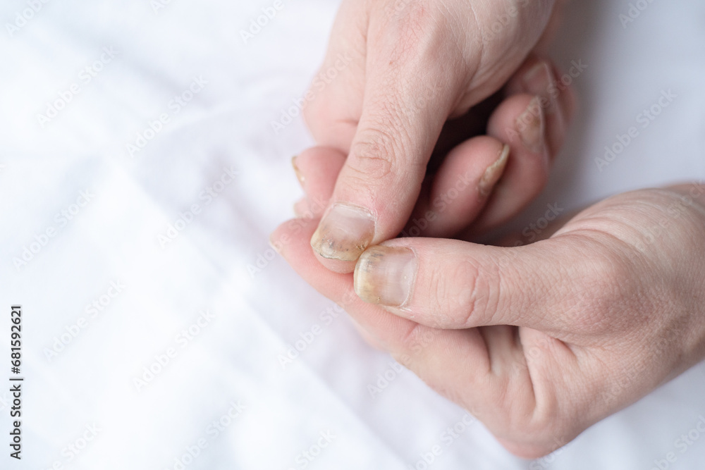 Male cut nails with nail fungus. Fungal infection on hands finger with ...