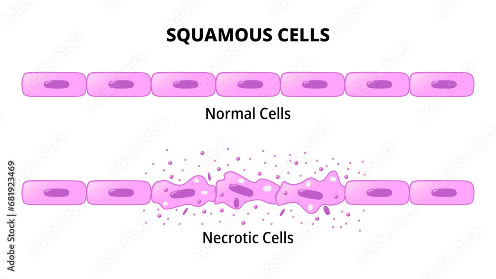 Squamous Cells - Normal Epithelial Cell - Necrotic Cell - Histology ...
