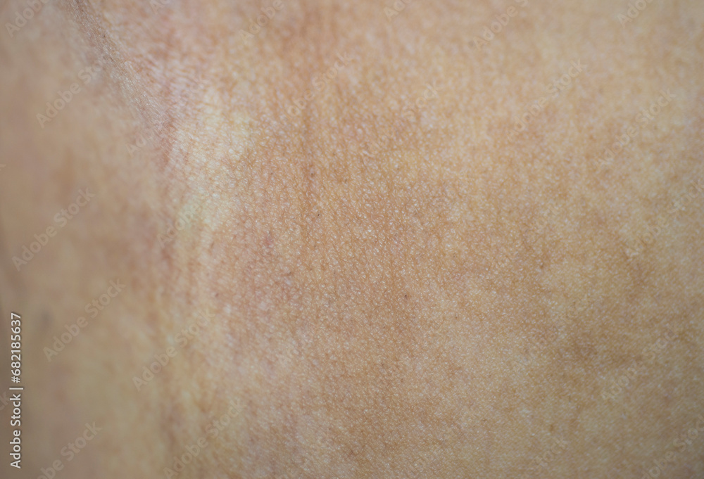 Picture of the problem of bumps and red rashes on the skin on the human ...