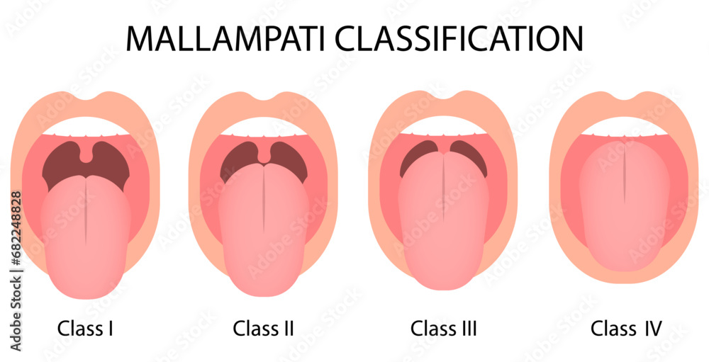 Mallampati Classification score. Oral airway intubation. Medical ...